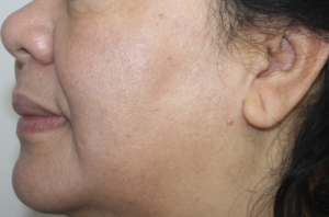 Chemical Peel - MC Modern Skin