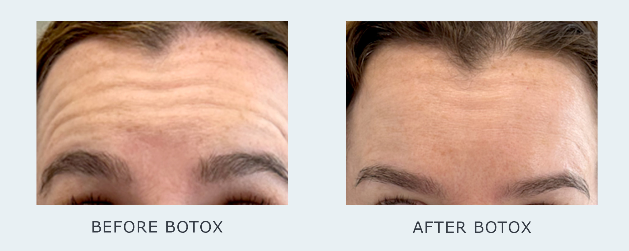 Botox Injections - MC Modern Skin