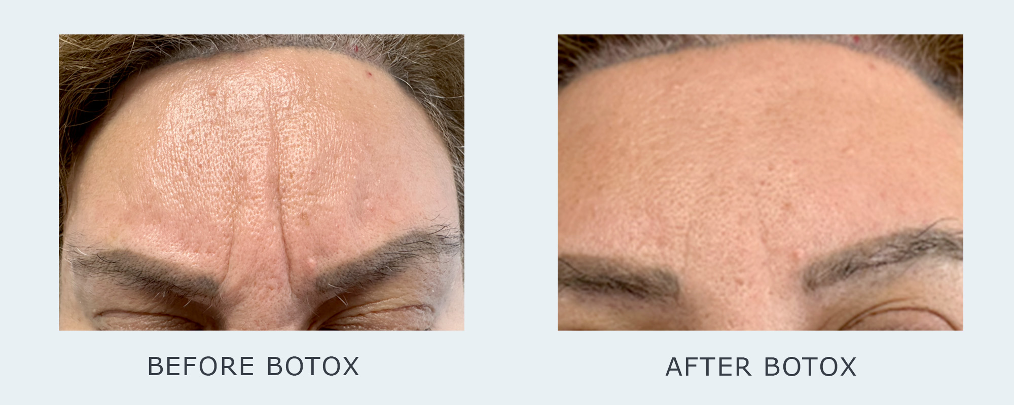 Botox Injections - MC Modern Skin