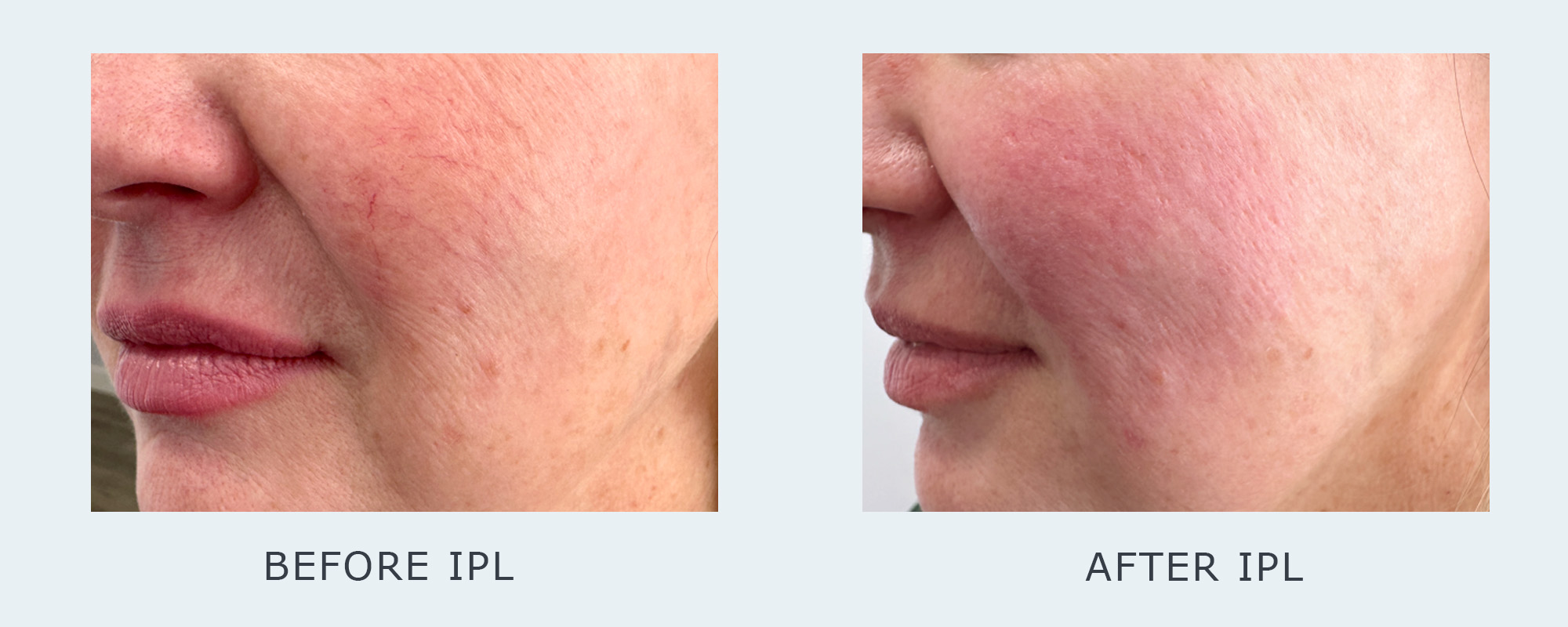 IPL Therapy Shoreline, WA - MC Modern Skin