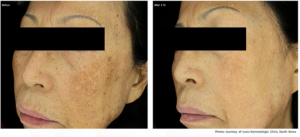 NOUVADerm™ laser Treatment - MC Modern Skin Shoreline